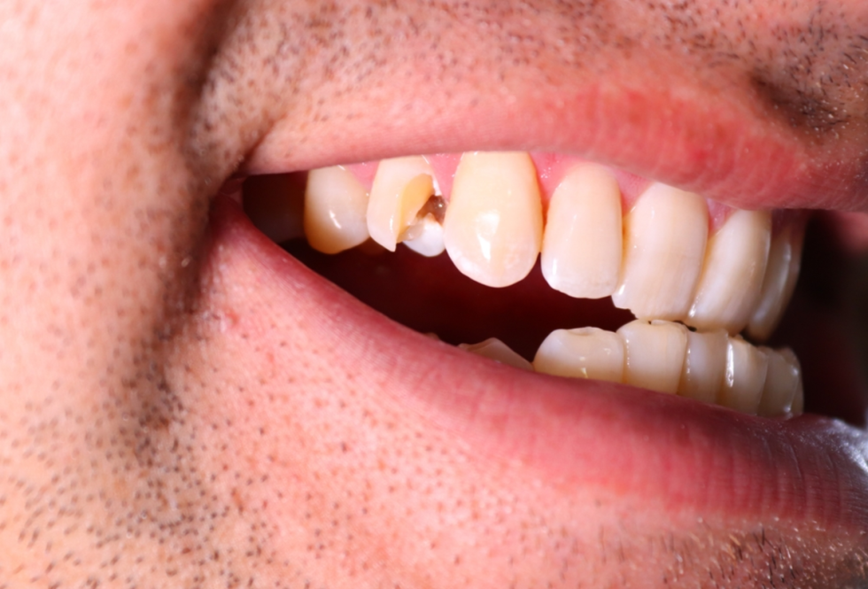 Broken Wisdom Tooth: Causes, Symptoms and Treatment Options